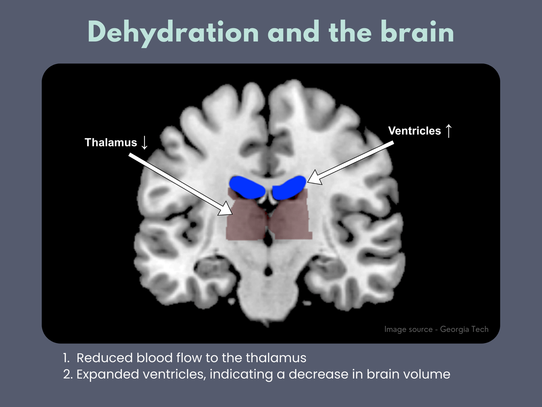Distracted and dehydrated: The link between ADHD and drinking enough water